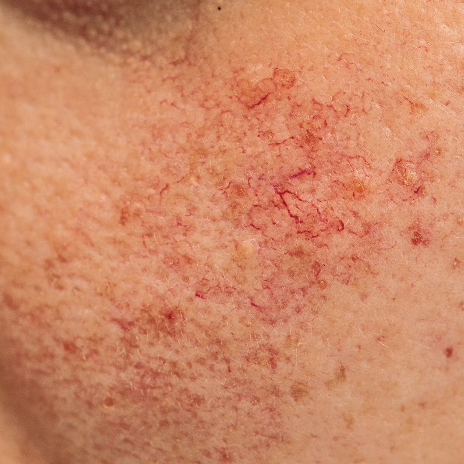 Broken Capillaries – Lucie Me Medical Spa